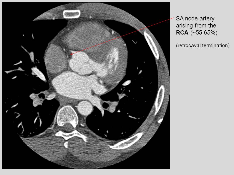 The Pump and the Tubes: The SA Node Artery