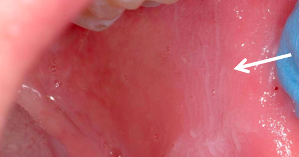 Morsure de joue: Symptômes, Causes, Traitement - Soins dentaires