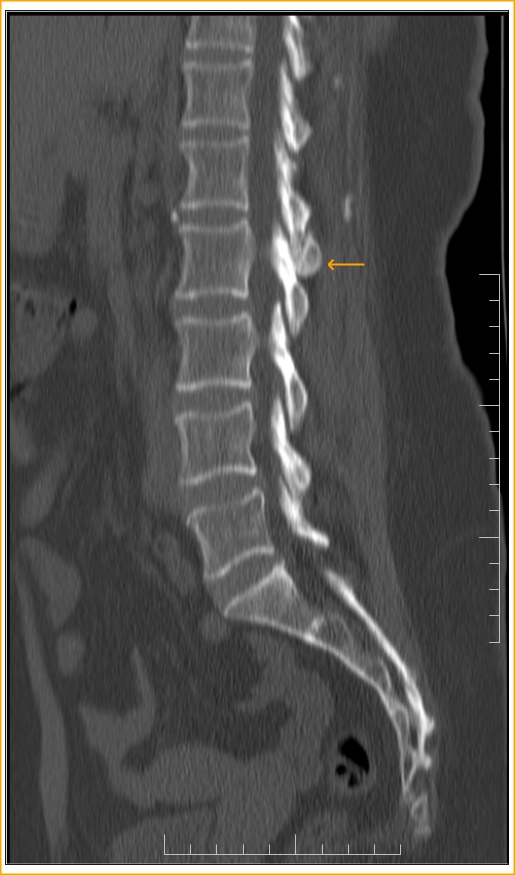 Spinous Osteochondroma-CT - Sumer's Radiology Blog