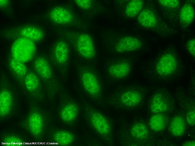 Anticorpos anti - SSA (Ro) e anti - SSB (La)