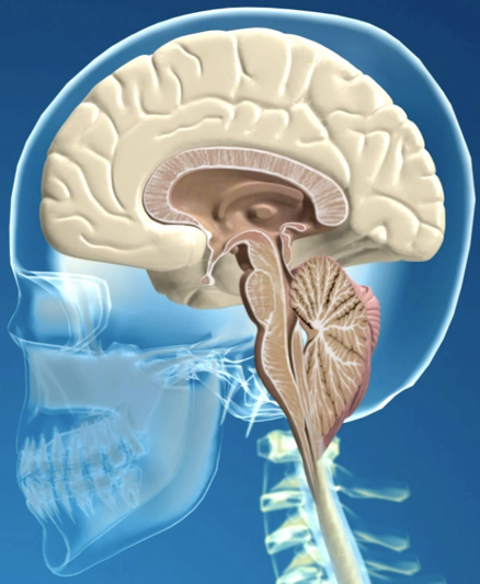 Malformazione di arnold-chiari