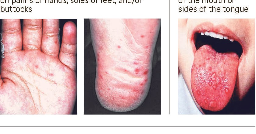 If Only Singaporeans Stopped to Think: Hand, Foot and Mouth Disease ...