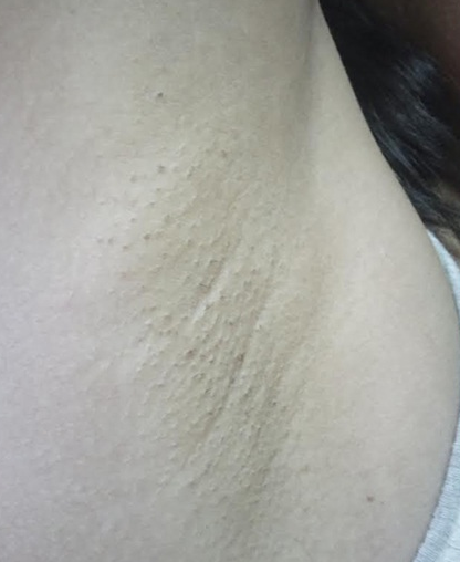 My Secret to Lighter and Smoother Underarms - Sar Writes