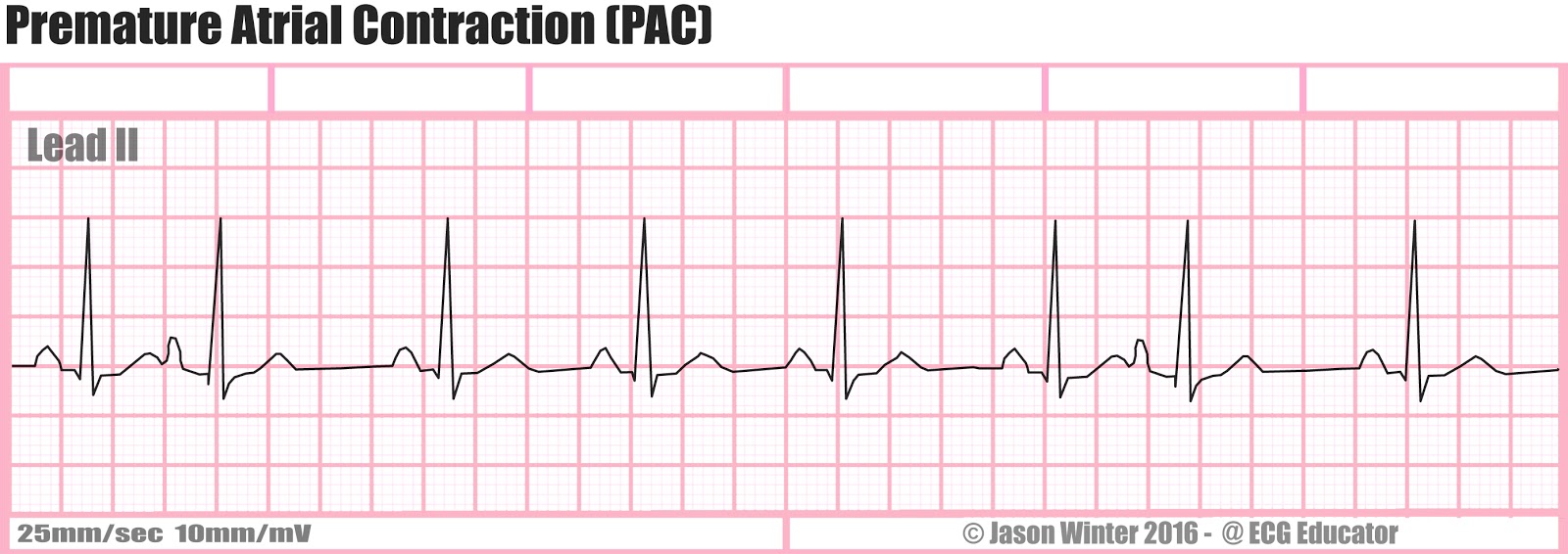 ECG Educator Blog : Six Second ECG Rhythm Strips