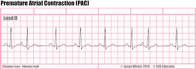 ECG Educator Blog : Six Second ECG Rhythm Strips