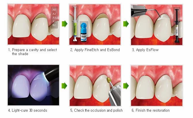 EsFlow Flowable Composite - Dental Supplies and Instruments