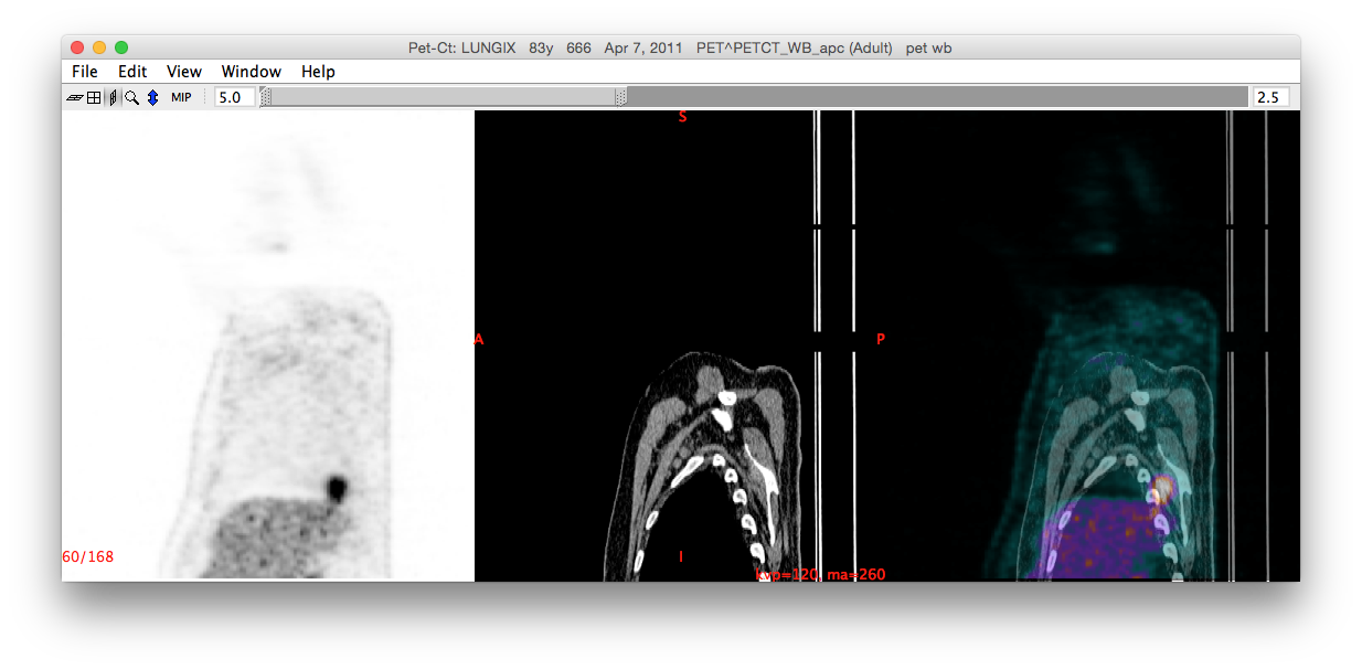 CT表示では、Cross sectionの緑のラインが邪魔なときは、ラインの長さを調整できます。