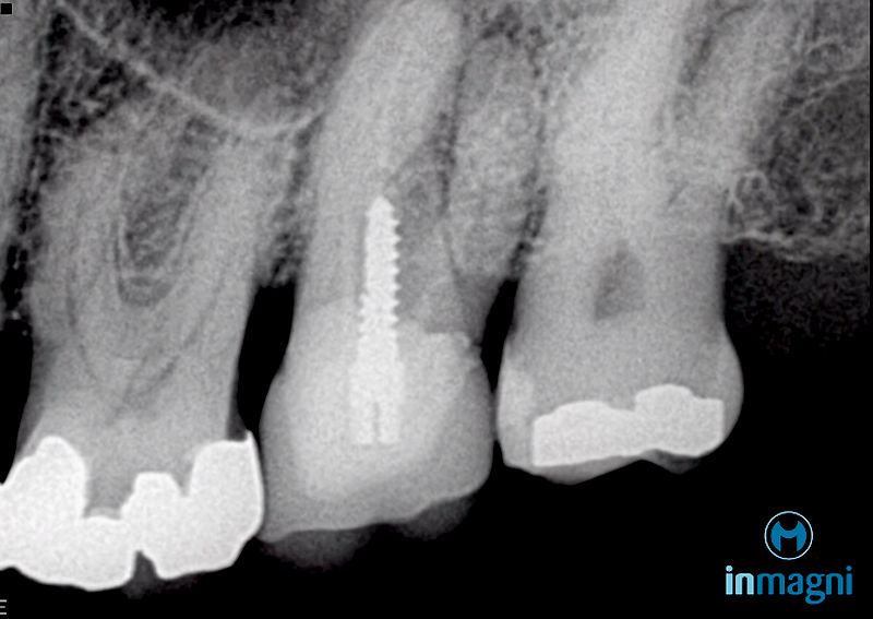 ENDODONTIA: Retratamento de canal com remoção de pino metálico sem ...