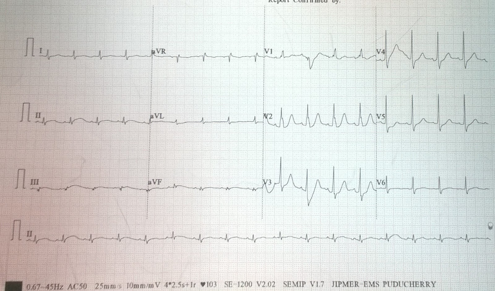 Cardiology window: Acute posterior wall myocardial infarction with ...