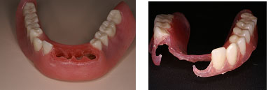 Premium partial and full dentures | Straight from the Dentist's ...