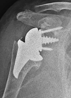 Shoulder Arthritis / Joint Replacement : Reverse total shoulder - does ...