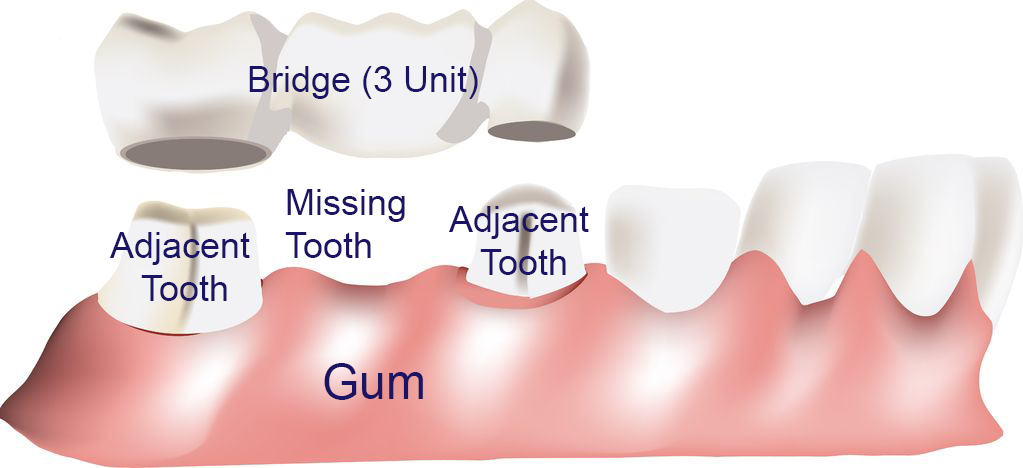 What Is The Difference Between A Bridge And A Partial Denture? | Tooth ...