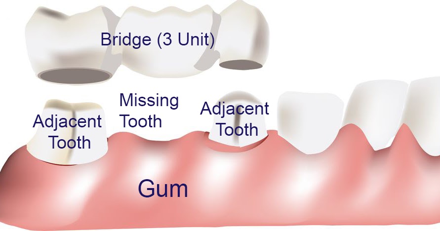 What Is The Difference Between A Bridge And A Partial Denture? | Tooth ...