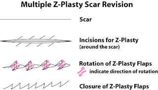 OTMANAGE: Plastic surgery Z plasty