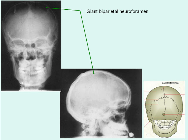 Skull and Spine: Biparietal foramen