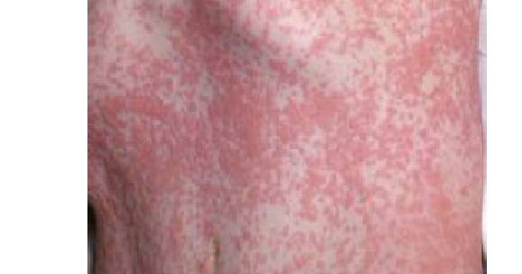 Exanthematous Drug Eruption ~ Panduan Praktik Dokter di Fasilitas ...