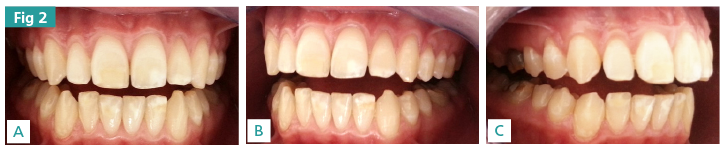Molar Incisor Hypomineralization (MIH): Conservative Treatment Approach