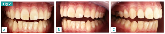 Molar Incisor Hypomineralization (MIH): Conservative Treatment Approach