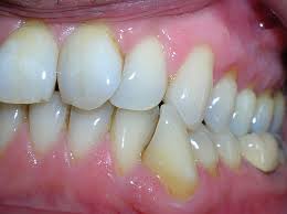 odontología preventiva: MATERIA ALBA