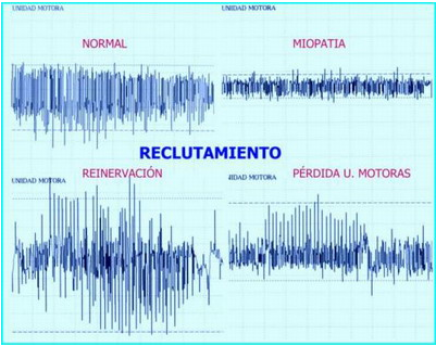 NEUROLOGÍA : ELECTROMIOGRAFIA