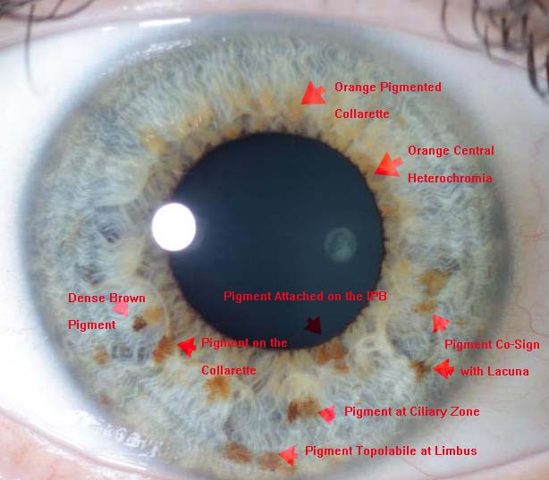 Modern & Multidimensional Iridology: Iris Pigmentation - Color, Density ...