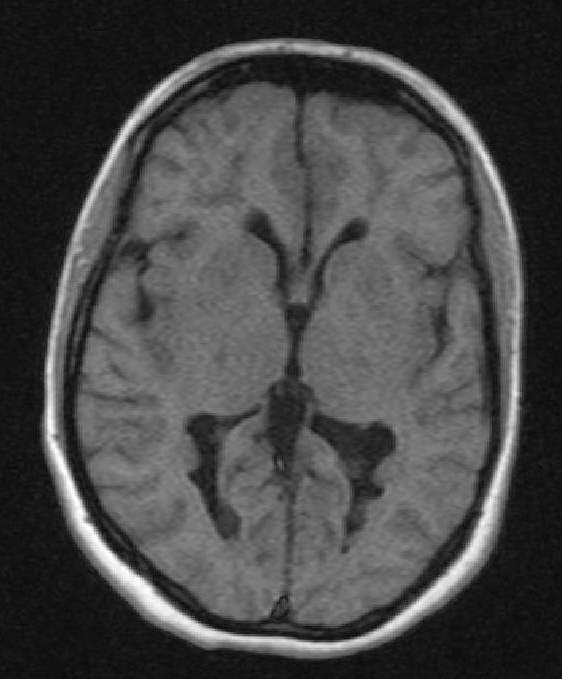 Heterotopia-MRI - Sumer's Radiology Blog