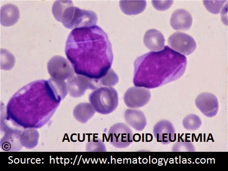 Lab Atlas: Acute Myeloid Leukemia