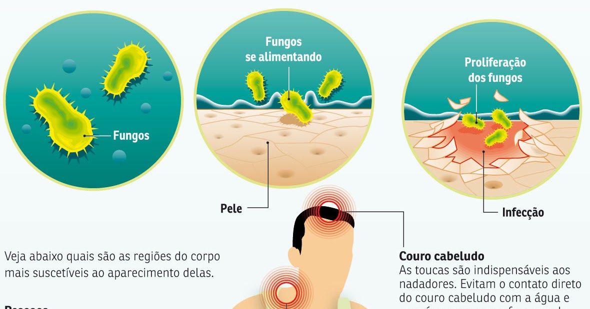 Blog Professor Robson: INFOGRÁFICO: MICOSES