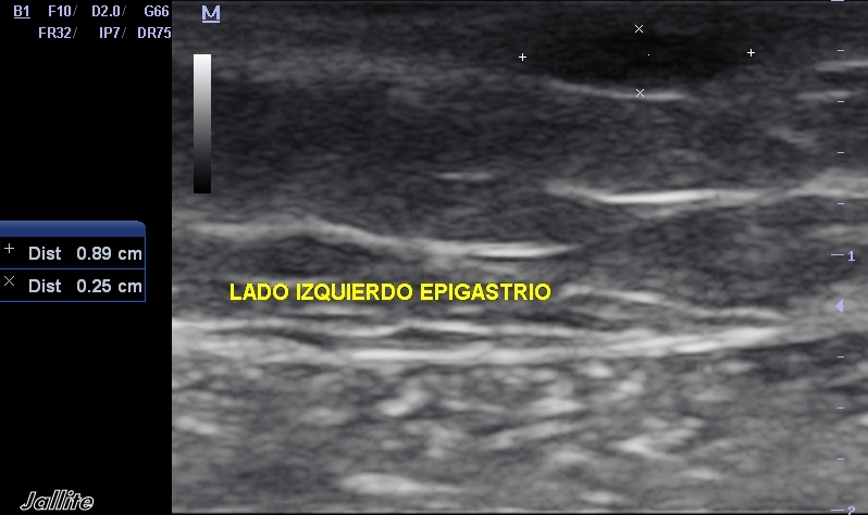 Abscesos Multiples Pared Abdominal I
