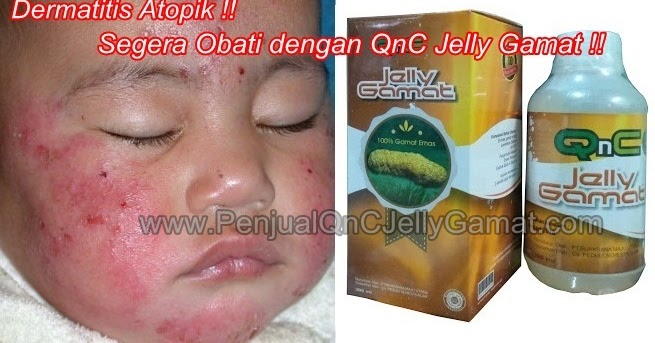 Obat Penghilang Dermatitis Atopik Tradisional, 100% MUJARAB ...