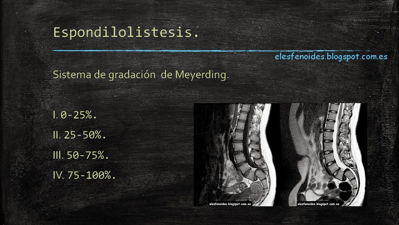El esfenoides: Sistema de gradación de Meyerding en la espondilolistesis.