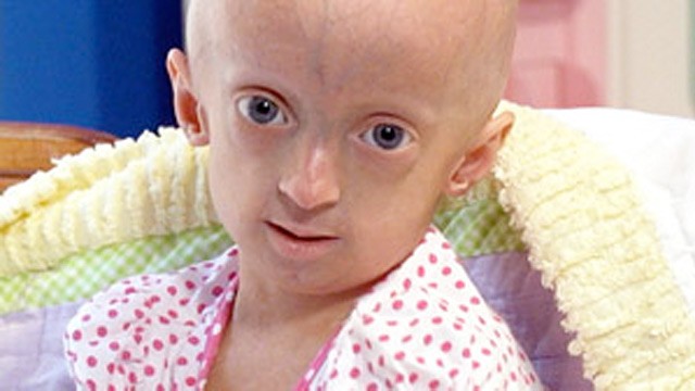 FranovikGivesBack: Franovik gives back to Progeria Charities