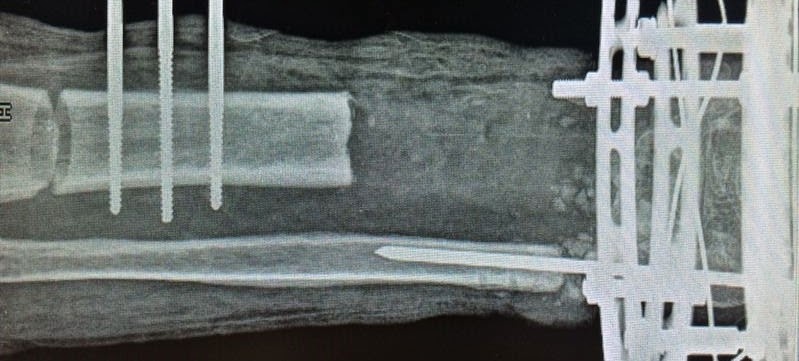 Ortopedia Pediátrica y Alargamientos Óseos: Dr. Luis Alberto Harfush ...