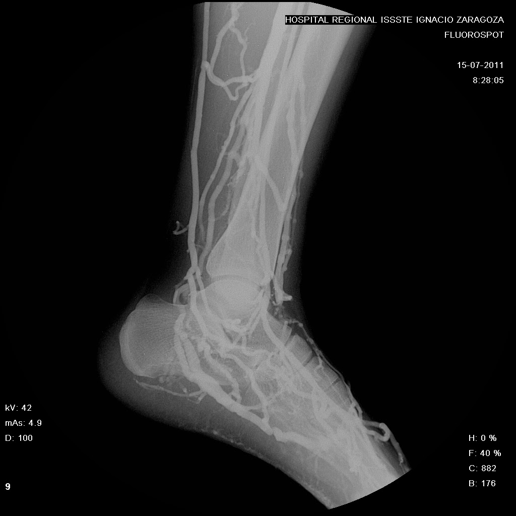 RADIOLOGIA e IMAGEN CETIS 76: FLEBOGRAFIA (extremidades inferiores)
