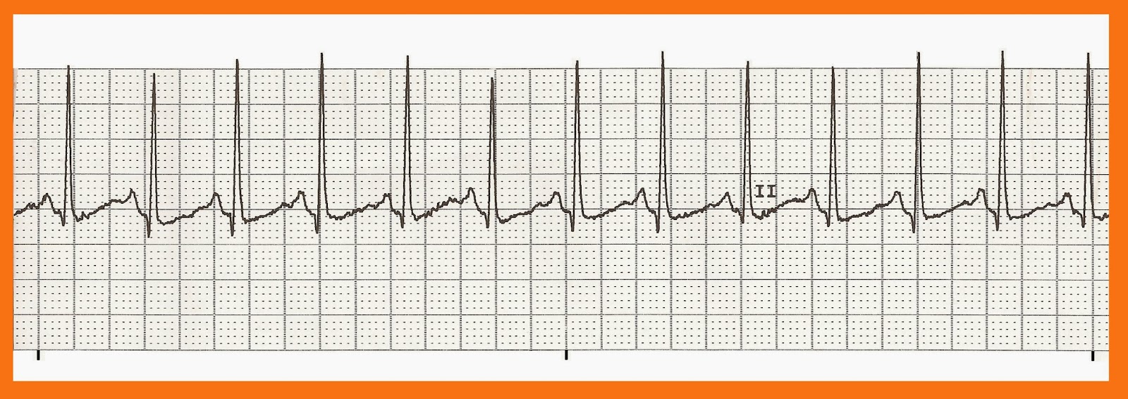 EKG Rhythm Strip Quiz 205