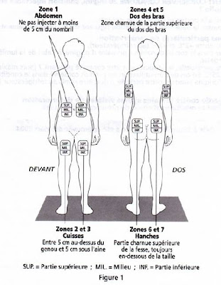 SEP à Coeur Ouvert: Les zones d'injection