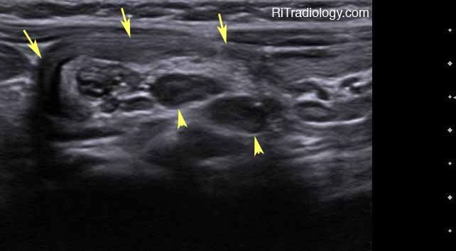 RiT radiology: Intussusception: Ultrasound