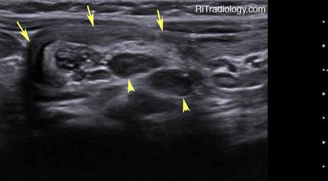 RiT radiology: Intussusception: Ultrasound