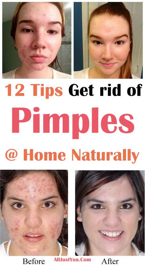 How to Get Rid of Pimples / Acne in a Week?