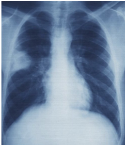 Abses Paru-Paru (Lung abscess)
