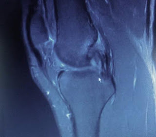 PCL Reconstruction-MRI - Sumer's Radiology Blog