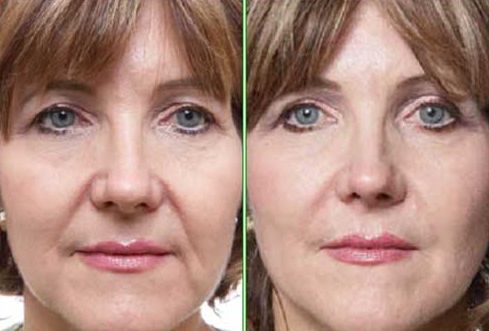 Facial Exercises For A Younger Look And The Ultimate Non-Surgical ...