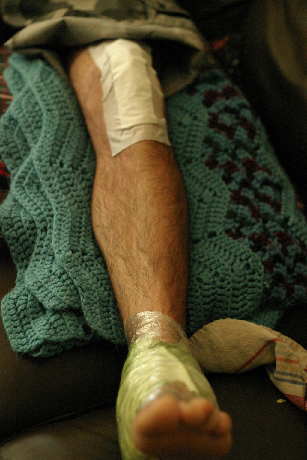 Cabbage On Swollen Feet at Donald Peterson blog