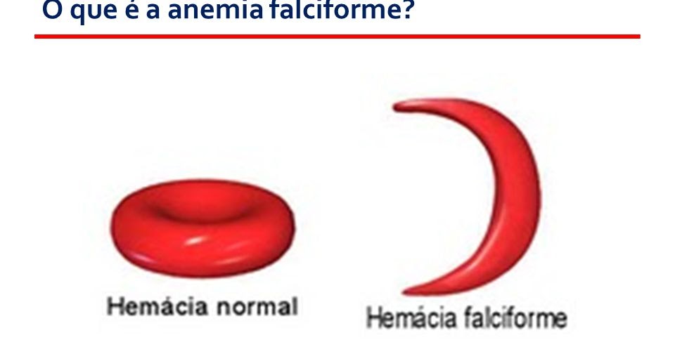 RosaBio: Anemia Falciforme