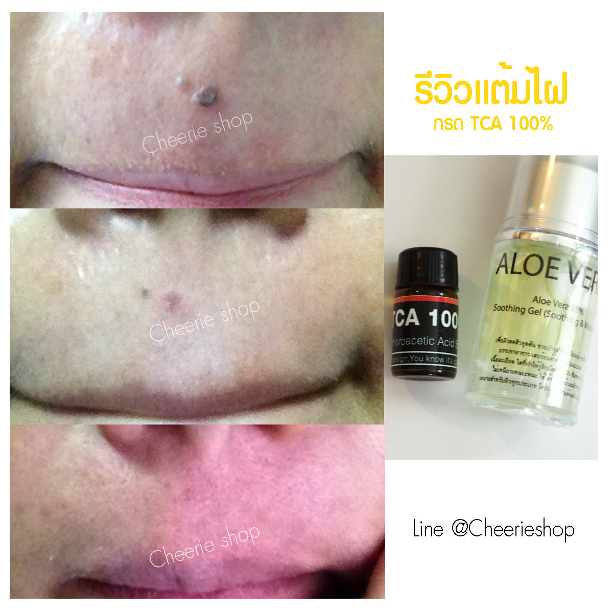 กรดTCA 100% 50% ใช้อย่างไร ให้เกิดประโยชน์ ไม่นำโทษมาให้เคืองใจ