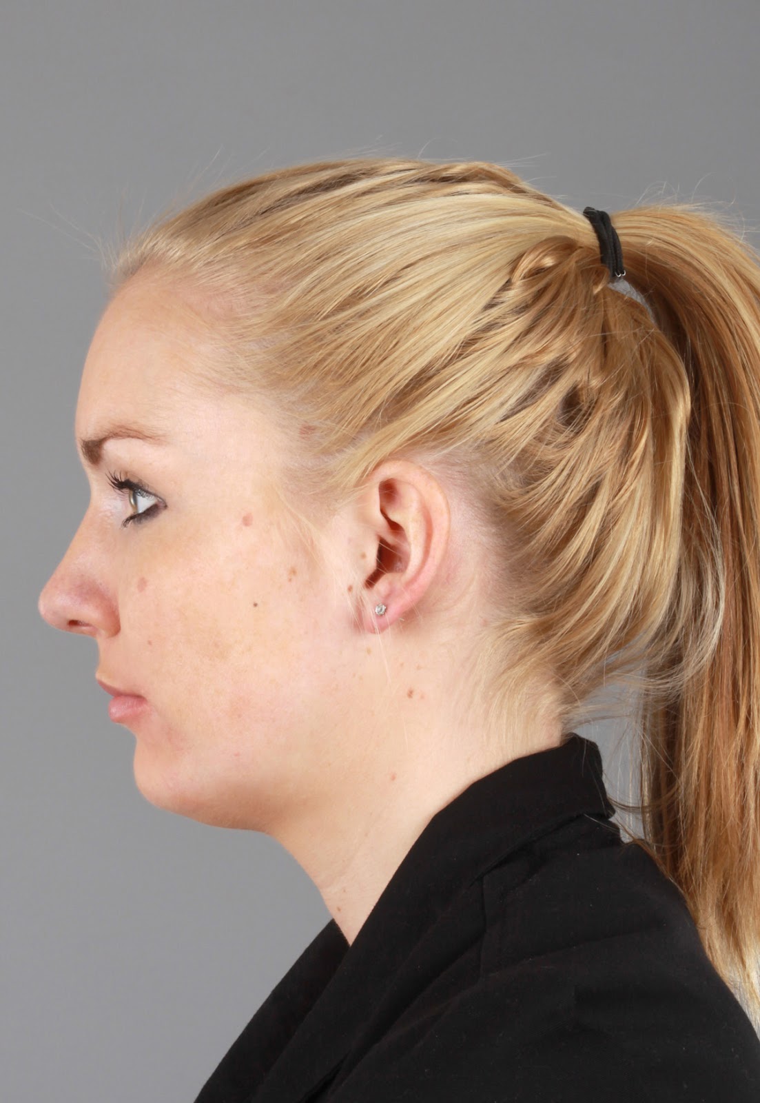 Cindy's kaakoperatie: Fotoserie