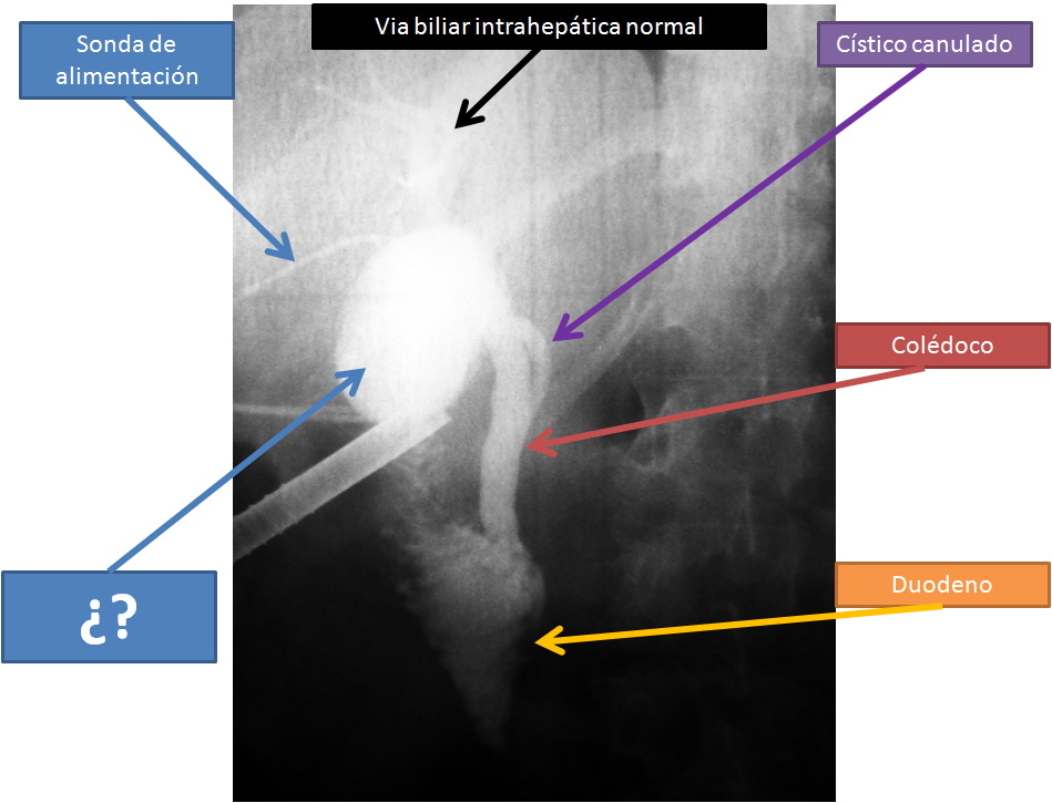 Soluciones Quirúrgicas: ¿Qué es una colangiografía intraoperatoria?