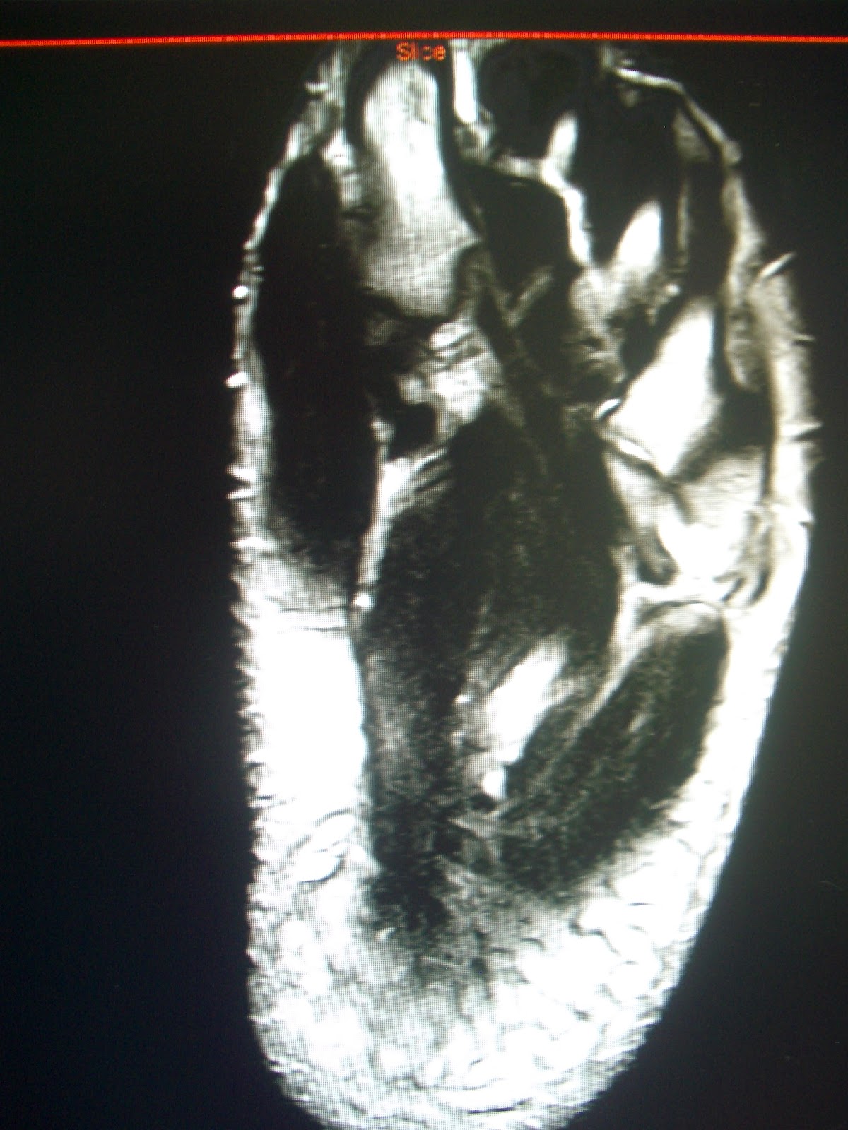 Podo Basas al Día: Fascitis plantar. Micosis intertriginosa. Papiloma ...