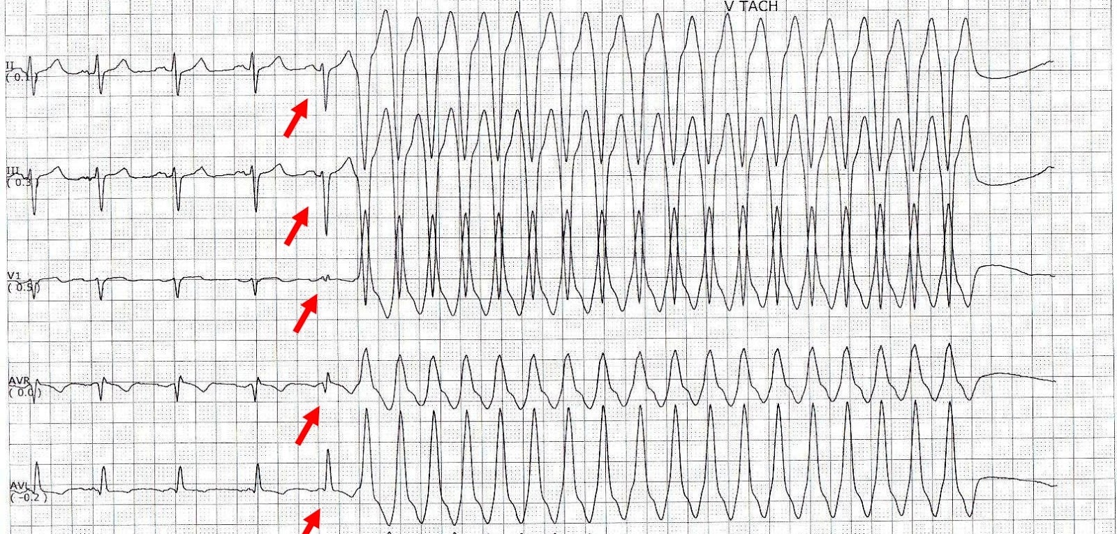 ECG Rhythms: Mastering ECG interpretation in Telemetry Units # 1