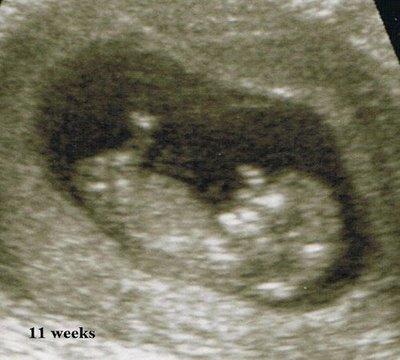 1º Bebê: 11ª Semana de Gestação do Bebê